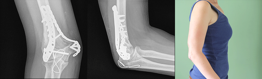 One armed in the gym – things you CAN do with a broken elbow – Rachel ...